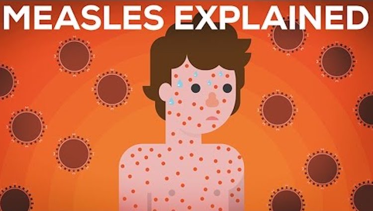 An Easy-to-Understand Animation Showing How Measles Work and How ...