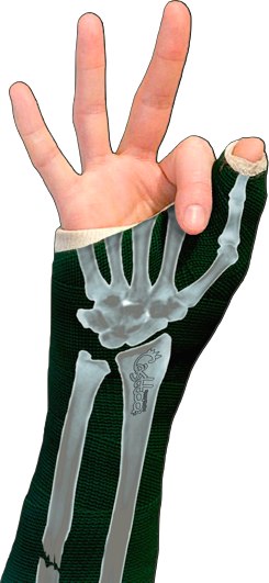 Casttoo, Tattoos For Your Cast
