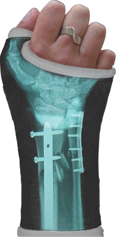Orthopedic Casts Custom Designed With Your Own X-Ray